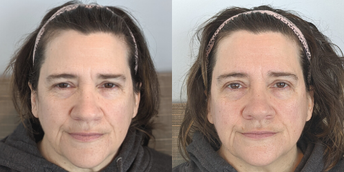 Zone Face Lift - Willow Therapies